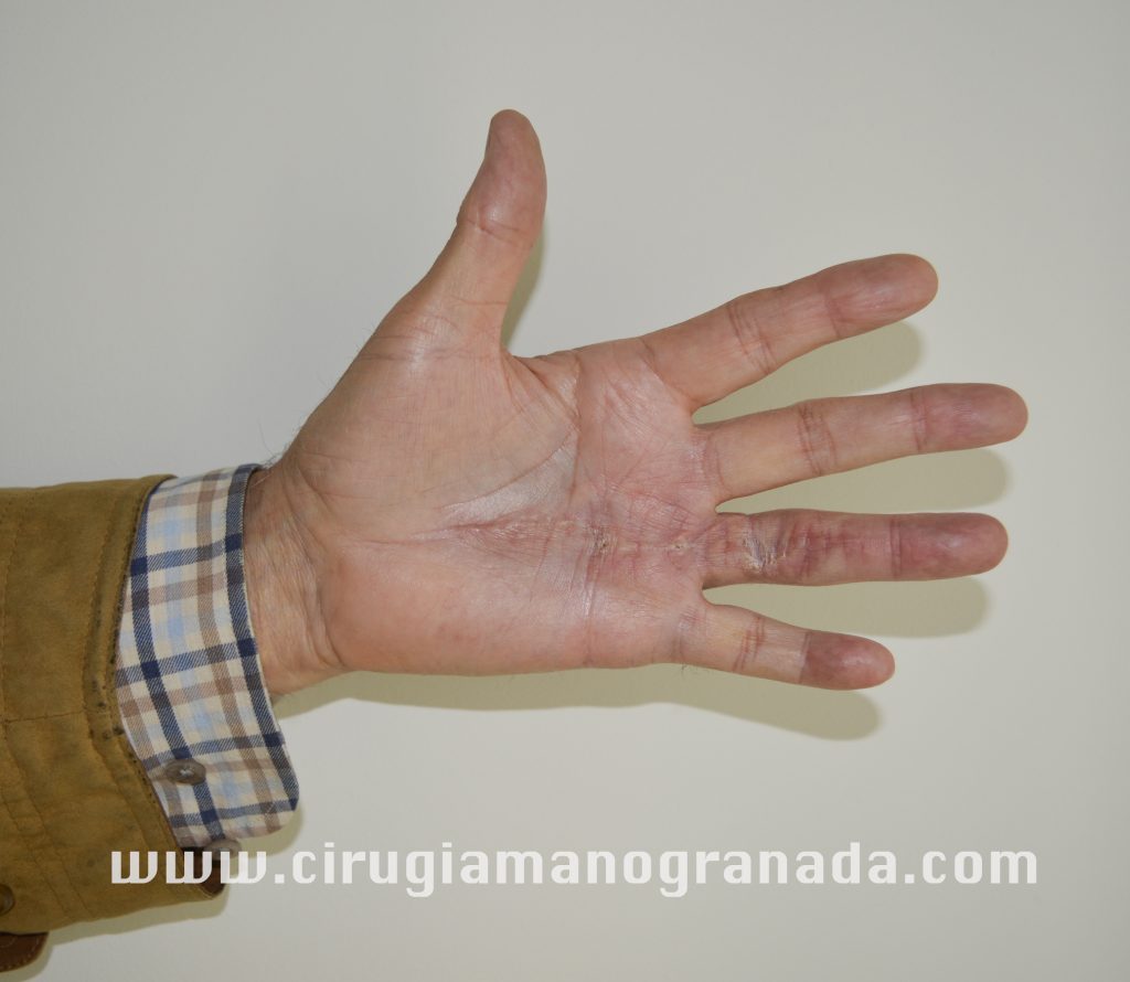 Cirugia Mano Granada | Enfermedad de Dupuytren